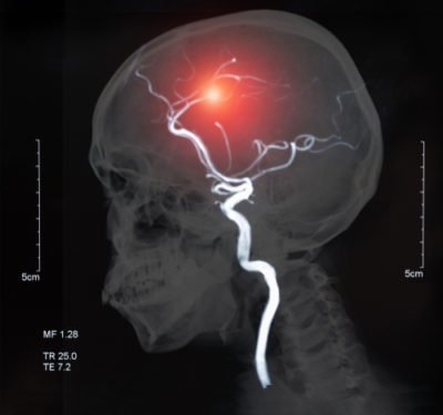 Angiography of the Brain | Radiology Clinic | Rockville MD