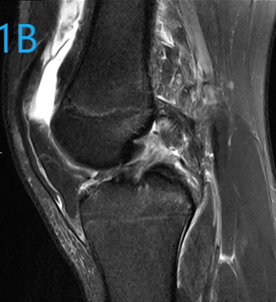 MRI- Finding the Cause of Knee Pain | Rockville MD | Radiology Center