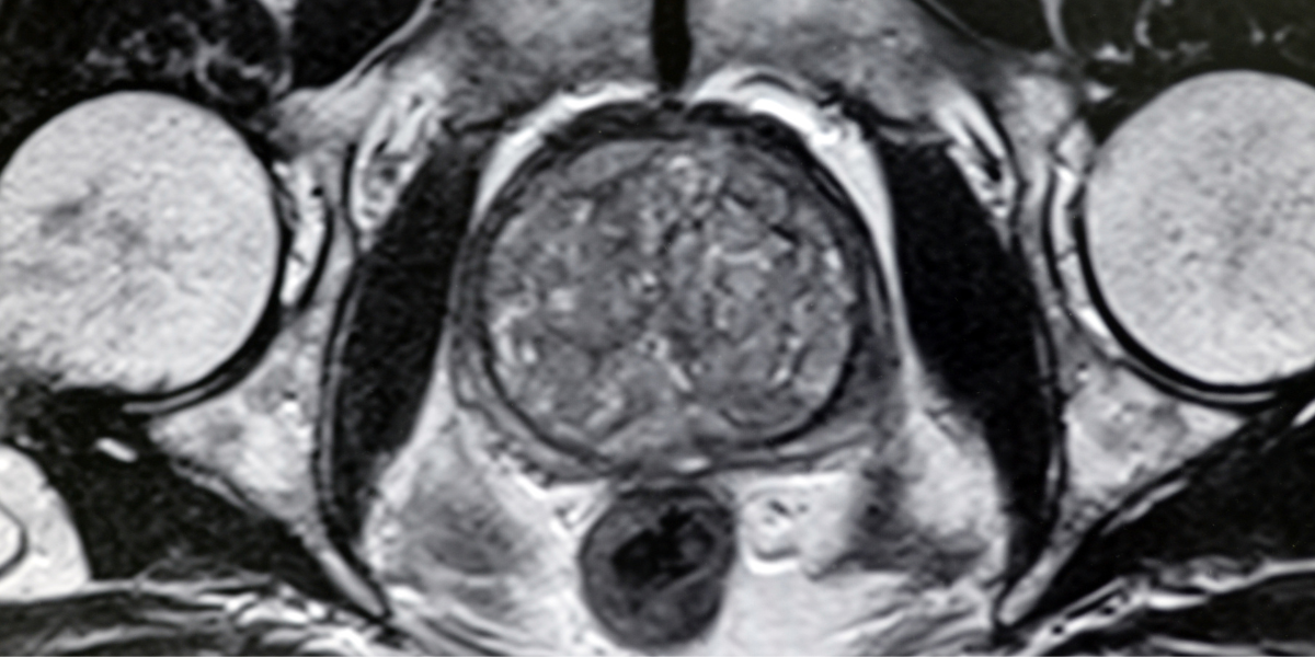 Prostate MRI: A Vital Tool for Men’s Health - The Radiology Clinic